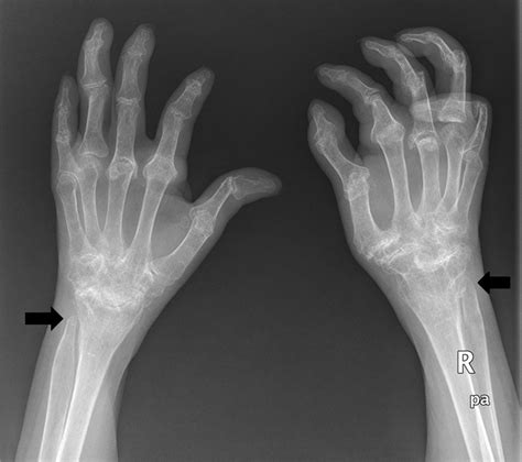 Systemic Sclerosis Associated Acro Osteolysis And Tumor Necr Jcr Journal Of Clinical