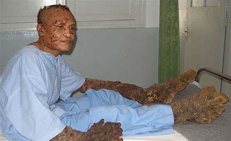 Rare Diseases And Rare Medicines Tree Like Structure Growing On Human Body Due To Papilloma Virus