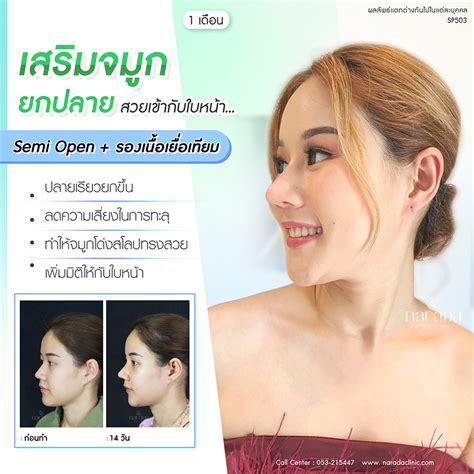 เสริมจมูกยกปลาย สวยเข้ากับใบหน้า เสริมจมูก รองเนื้อเยื่อเทียม เทคนิค Semi Open