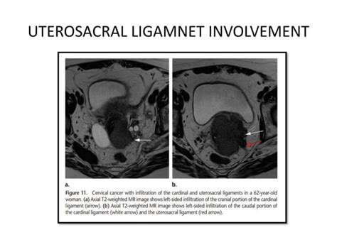 Target Delineation Of Parametrium Pptx Target Delineation Of Parametrium Pptx