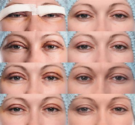 Exercise After Blepharoplasty ⋆