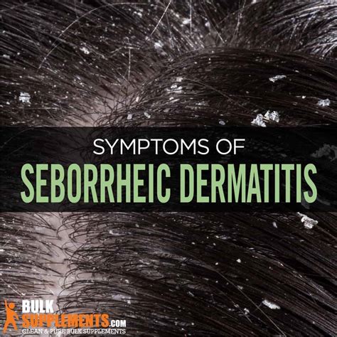 Mild Seborrheic Dermatitis Scalp Seborrheic Dermatitis Of The Scalp