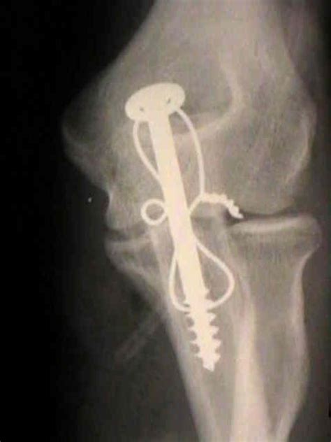 Left Olecranon Fracture Exoticmumu
