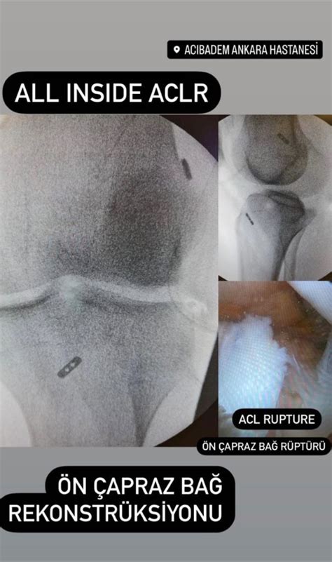 Arthrex All Inside Acl Reconstruction Murat Bozkurt Acibadem Ankara