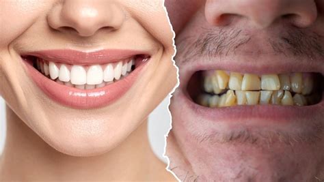 Healthy Teeth Vs Unhealthy Teeth What Most People Miss Meridian