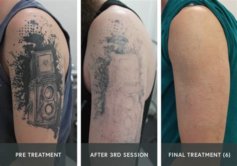 Tattoo Removal In Calabasas And Beverly Hills California