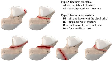 Scaphoid And Lunate Fossa
