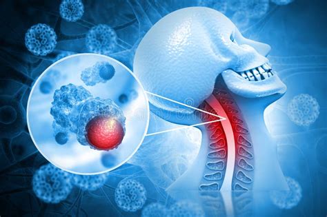 Thyroid Gland Cancer Showing Thyroid Gland With Tumor Stock