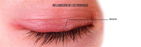 Trastornos De Los Párpados Clínica Oftalmológica Vista Sánchez Trancón