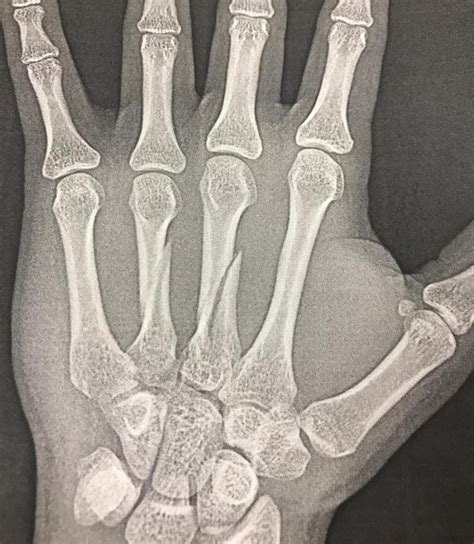 Broken 3rd And 4th Metacarpal R Brokenbones