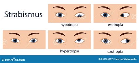 Strabismus Flat Style Infographic Set Of Stages Normal And Disorders European Person Stock