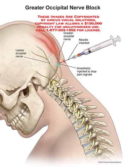 Occipital Nerve Block Needle