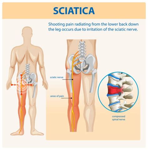 Sciatica Slipped Disc Dr Rohit Anand