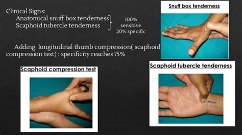 Scaphoid Fracture And Perilunate Dislocation