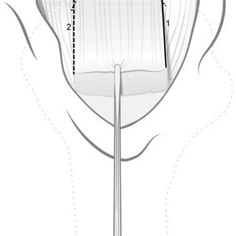 Isakos Rotator Cuff Tear Classification System Location L Extension