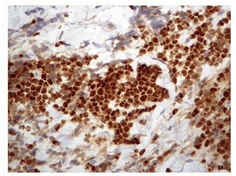 Precursor T Cell Lymphoblastic Lymphomaleukemia Thoracic Key