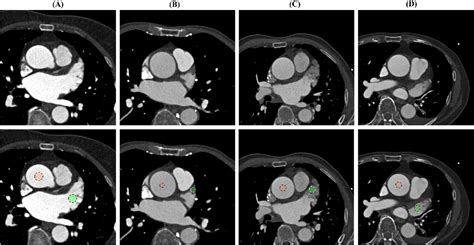 Figure 1 From Deep Learning Based Automatic Left Atrial Appendage