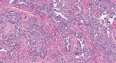 Uterine Tumour Archives Atlas Of Pathology