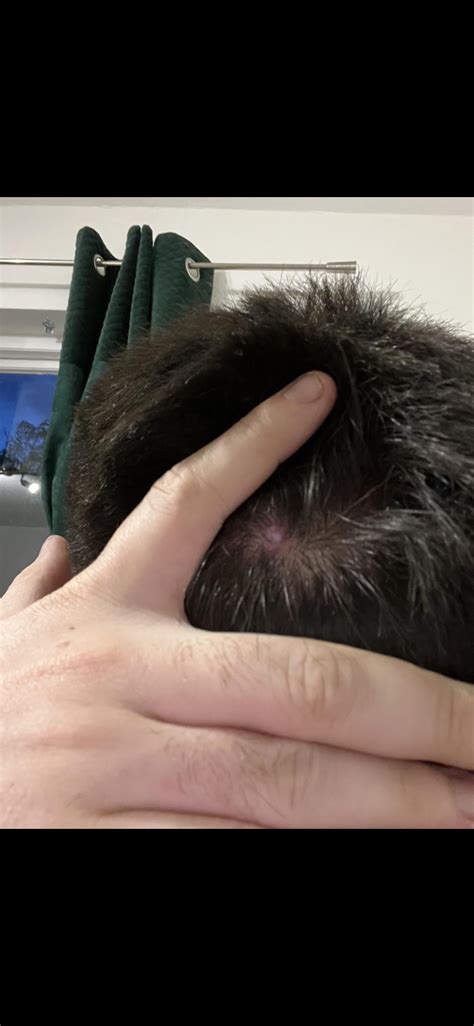 Mole Or Cyst On Scalp…concerning R Dermatologyquestions