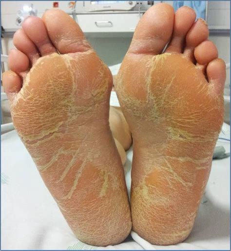 Xanthogranulomatous Pyelonephritis Presenting As Palmoplantar Keratoderma Bmj Case Reports