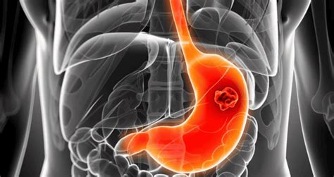 Guía Clínica Para El Diagnóstico Y El Tratamiento Del Cáncer Gástrico