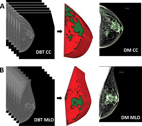 Fully Automated Volumetric Breast Density Estimation From Digital Breast Tomosynthesis Radiology
