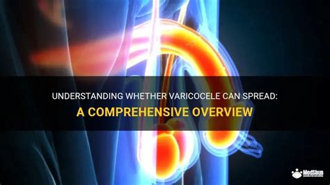 Understanding Whether Varicocele Can Spread A Comprehensive Overview