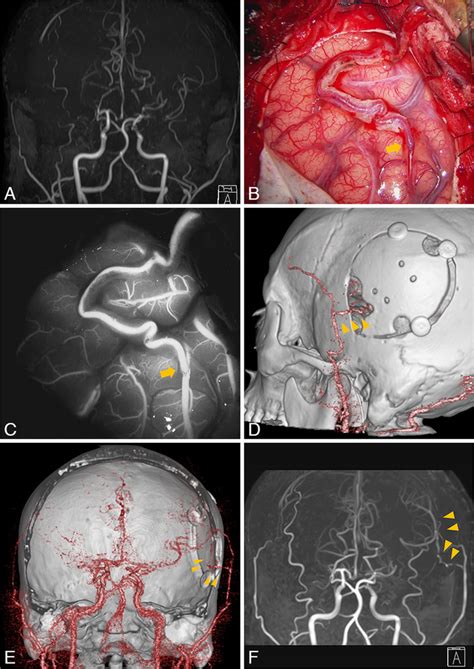 Visualization Of Extracranial Intracranial Bypass In Moyamoya Patients