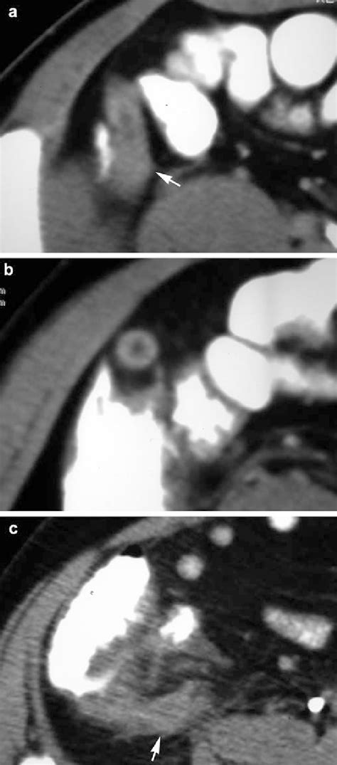 A C Transverse Ct Scans Of The Pelvis Reported As Probable Download Scientific Diagram