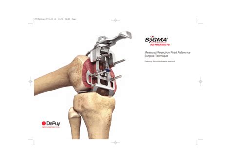 Measured Resection Fixed Reference Surgical Technique Instruments