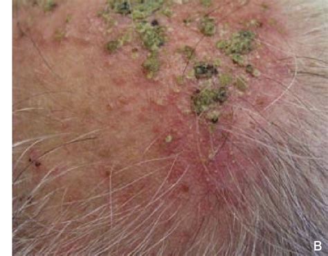 Folliculitis Scalp