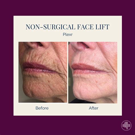 Non Surgical Face Lift Conquer 180