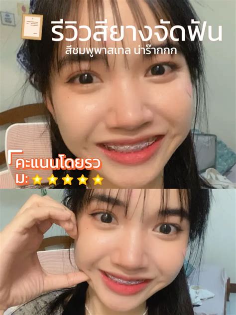 รีวิว ยางจัดฟันเชนสีชมพู 🩷 บาร์บี้ 🦷 แกลเลอรีที่โพสต์โดย Eeeeensur