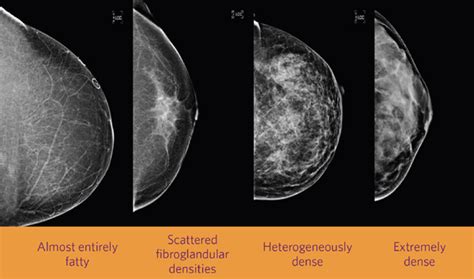 Invenia Abus Breast Cancer Screening Technology