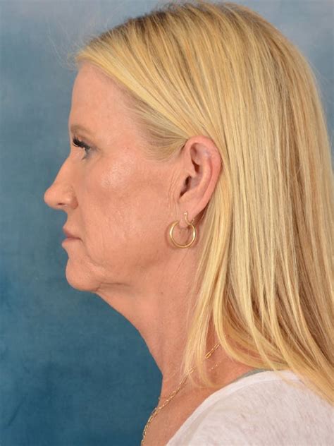 Patient 254394 Facelift Before And After Images Dr Sidney Starkman