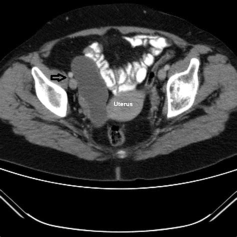 Pdf Low Grade Appendiceal Mucinous Neoplasm Mimicking An Adnexal Mass