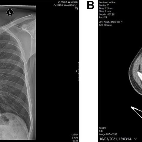 A Chest X Ray Linear Nodular Density Right Upper Lobe B Ct Thorax Download Scientific