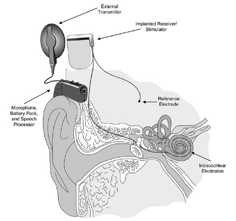 Cochlear Implant Diagram Cochlear Implant An Overview