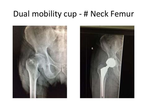 Dual Mobility Cups 6