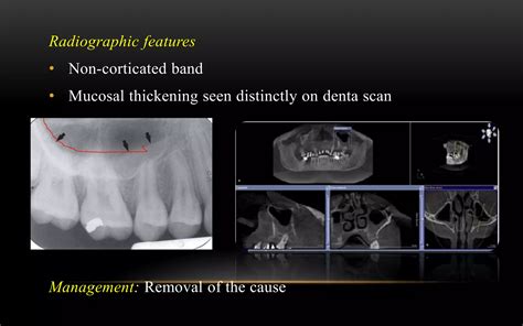 Differential Diagnosis Of Haziness Of Maxillary Sinus Pptx