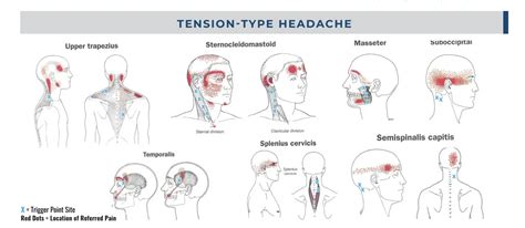 Trigger Point Referral Patterns Head And Neck Dental Sleep