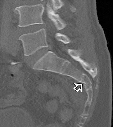 Sacrum And Sacral Fractures Wheeless Textbook Of 59 Off