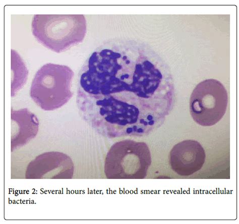 Staphylococcus Aureus Sepsis In A Patient With Secondary Acute