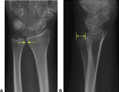 Radius Fracture Ulna Dislocation At Sophia Wiseman Blog