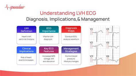 Understanding Lvh Ecg Left Ventricular Hypertrophy