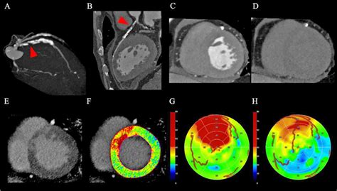 Figure 2 From Assessment Of Myocardial Viability In Chronic Myocardial Infarction Using The Dual