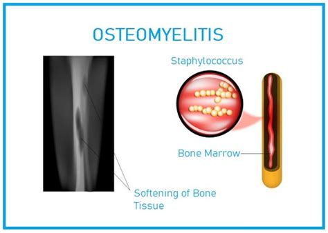 Limb Lengthening And Osteomyelitis