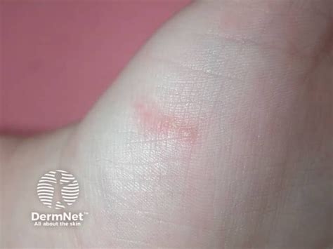 Dermnet Scabies Scabies