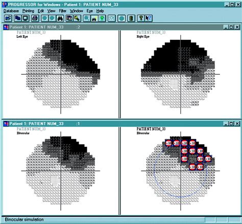 Manual Visual Field Test