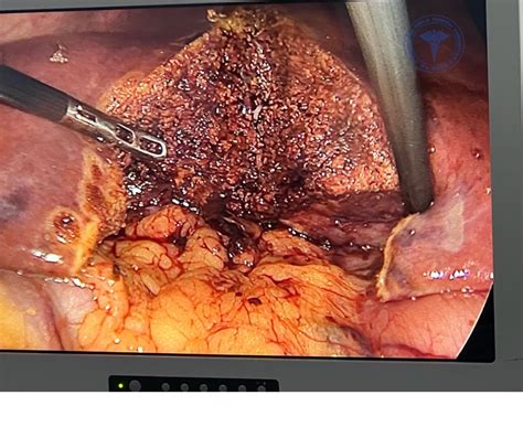 Resected Liver Specimen Laparoscopic Liver Resection Village Voice News